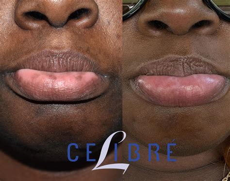 Brown Spots On Lips Treatments Results In 47 Days