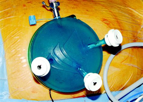 Laparoendoscopic Single Site Surgery In Gynecology Review Of