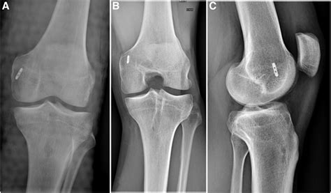 Arthroscopic Confirmation Of Femoral Button Deployment During Posterior