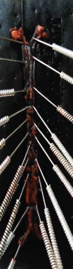 Aortic Atherosclerotic Plaques Oil Red O Staining Ac Aortic