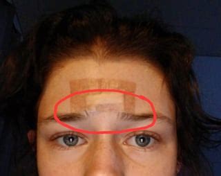 Can My Eyebrows Be Permanently Stuck In A Worried Expression After