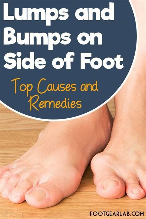 Lumps And Bumps On Side Of Foot Top Causes And Remedies Remedies