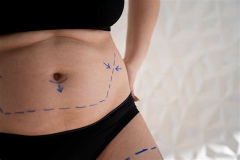 Tummy Tuck Scars How To Minimize And Treat Them Smart Plastic Surgery
