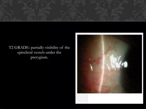 Pterygium And Its Management Pptx