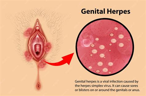 Premium Vector Genital Herpes Infographic With Explanation