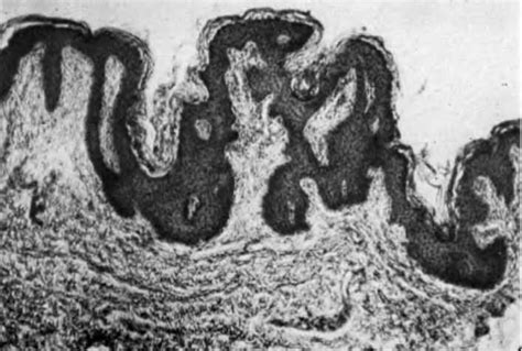 Acanthosis Nigricans Histology