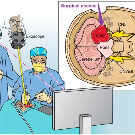 Illustration Of A 3d Exoscope View Detailing The Relevant Anatomical