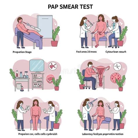 Ilustración Que Muestra El Proceso De Prueba De Papanicolau En Seis