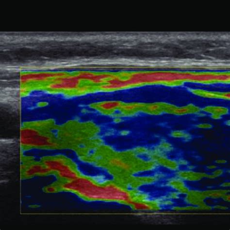 Elastogram Of Right Thyroid Lobe 32 Cm Solid Nodule Real Time Applied