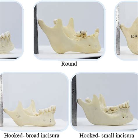 Different Shapes Of Coronoid Process Download Scientific Diagram
