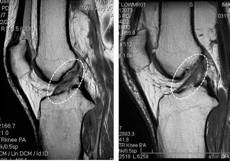 Mri Knee Acl Tear
