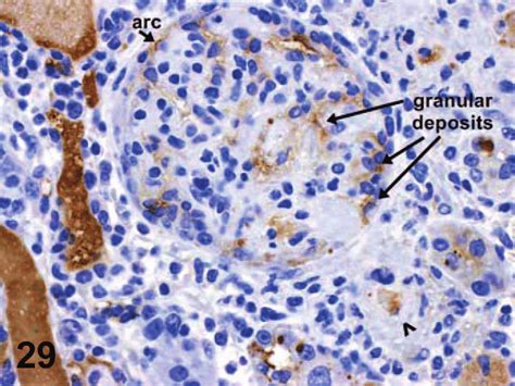 Drug Ada Containing Ics In Acute Glomerulopathy And Associated