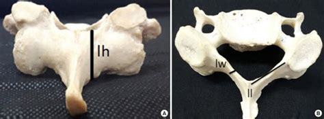 Morphometry Of The Uncinate Process Vertebral Body And Lamina Of The