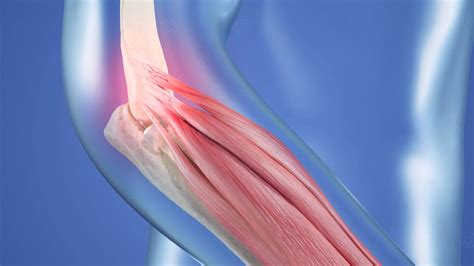 Animation Treatment Epicondylitis Medicalgraphics