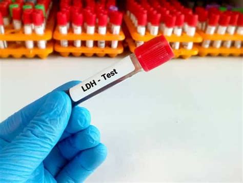 Ldh Serum Test Mrldc Diagnostic Centre