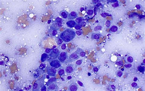 Osteosarcoma Archives Eclinpath