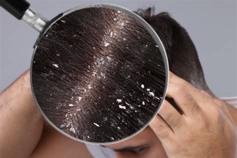 Caspa Grasa Causas Y Soluciones Luxéol