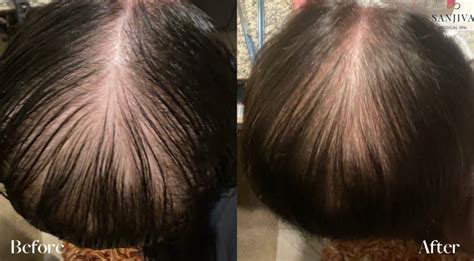 Exosomes For Hair Loss Treatment In Dallas The Latest In Hair Regrowth