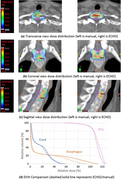 Automated Intensity Modulated Treatment Planning The Expedited
