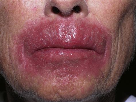 Oral Hypersensitivity Reactions Dermatologic Clinics