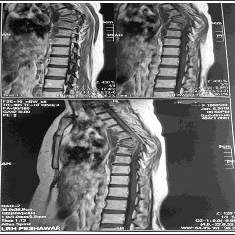 Sagittal Mri Showing Dorsal Spine Tb Image Included With Permission