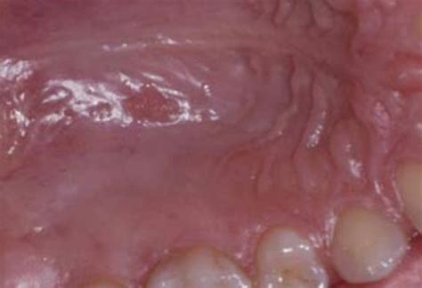 Condylome Acuminé Buccal Daprès Dridi Et Al 2009 Download