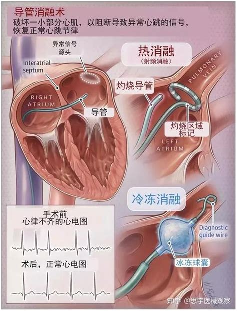心脏消融术的原理及发展趋势 行研 知乎