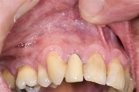 Gum Hyperplasia From Amlodipine Drug Stock Image C0168204