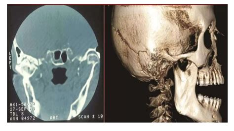 Disorders Of The Temporal Mandibular Joint Ppt
