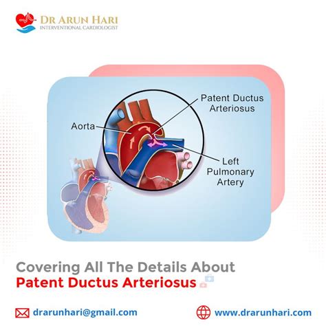 Covering All The Details About Patent Ductus Arteriosus Patent Ductus
