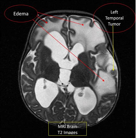 Case Studies Series Multiple Hemangiomas Neurosurgeons Located In