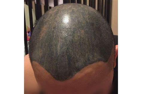 Botched Scalp Micropigmentation What Are Your Options Ftg Clinics Botched Scalp Micropigmentation What Are Your Options Ftg Clinics
