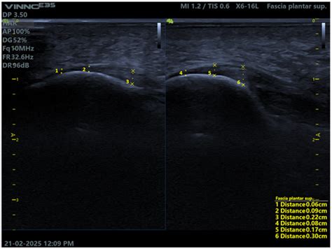 Comparative Evaluation Of Ultrasound Measurement Of The Plantar Fascia