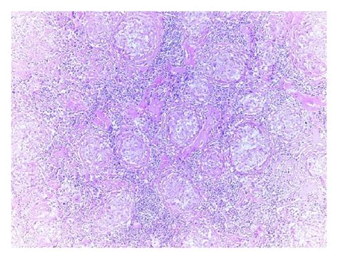 Noncaseating Granulomas In Lymphoid Tissue H E 10x Download