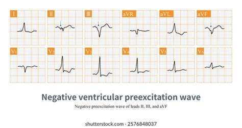 Qs Wave Ecg Over 15 Royalty Free Licensable Stock Illustrations