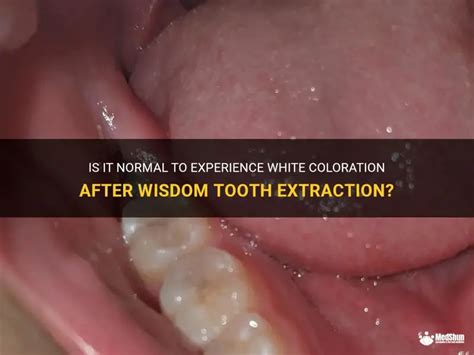 Is It Normal To Experience White Coloration After Wisdom Tooth