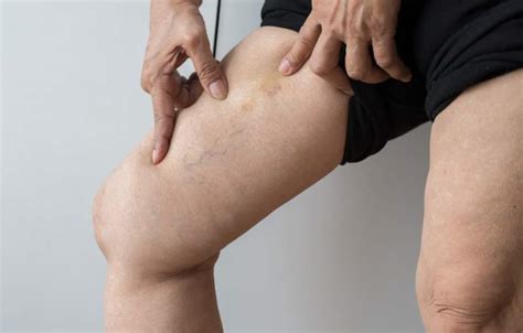Combien De Temps Dure Une Thrombose Veineuse Profonde Étape Santé