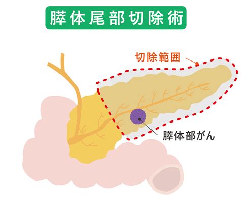 膵臓がん 加古川中央市民病院