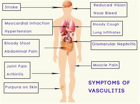 Atypical Presentation Of Vasculitis Problem A Middle Aged Man