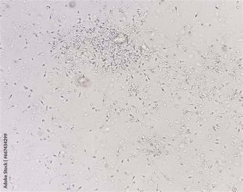 Semen Analysis Normozoospermia Analyzed By Microscope Normal Sperm