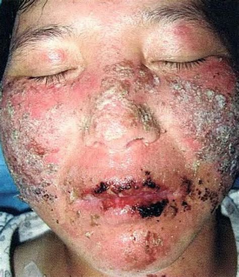 药物性红斑狼疮 医联