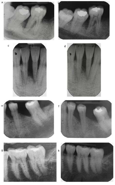 Examples Of Bone Regeneration Through Non Surgical Therapy A Large