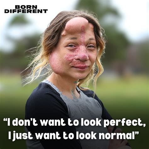 Born Jennifer Hiles Suffers From Avm Arterial Venous Malformation Avm Leads To Abnormal