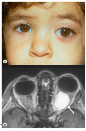 Neuro Optom Optic Nerve Disorders Part 2 Flashcards Quizlet