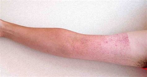 Petechiae From A Blood Pressure Cuff