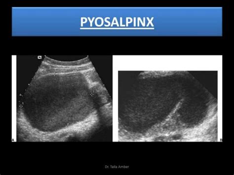 Transvaginal Ultrasound Presentation By Dr Taila Amber