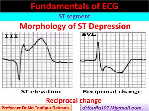 Approach To A Patient With St Segment Abnormality In Ecg Ppt