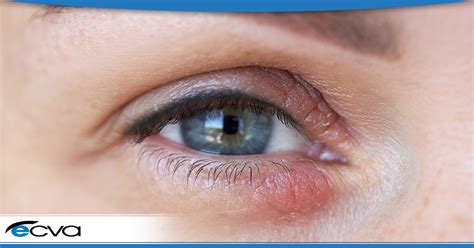 Contact Dermatitis Eyelids