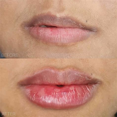 Lip Augmentation • Contouring And Reshaping Lip Enhancement Lip
