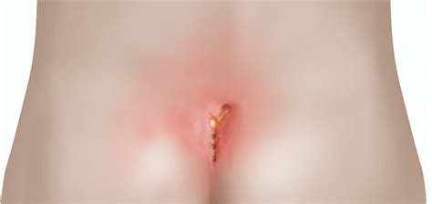 Surgery For Pilonidal Sinus Healthdirect